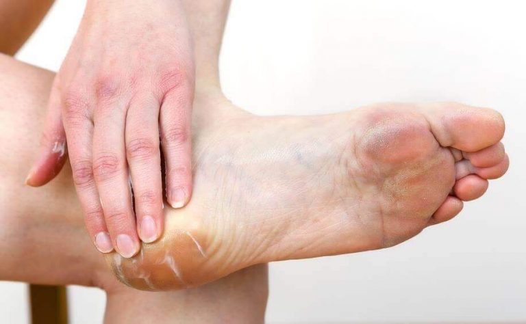 Cor au pied : un épaississement désagréable et très douloureux au ...